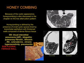 Patterns in HRCT chest | PPTX