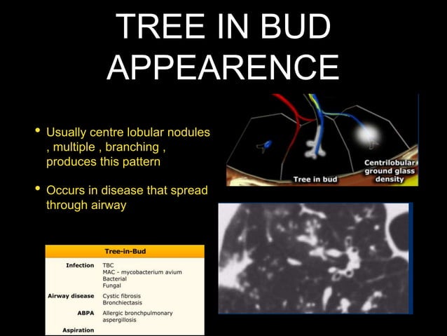 Patterns In Hrct Chest Pptx Lung And Respiratory Health Diseases And Conditions