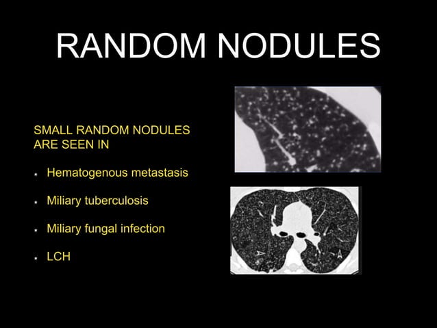 Patterns in HRCT chest | PPTX | Lung and Respiratory Health | Diseases ...