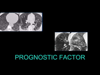 Patterns in HRCT chest | PPTX