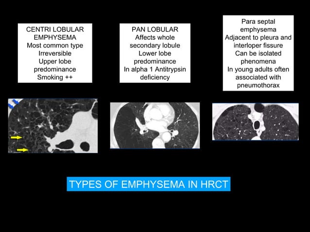 Patterns in HRCT chest | PPTX | Lung and Respiratory Health | Diseases ...