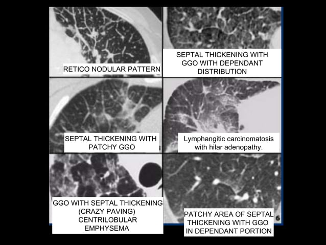 Patterns in HRCT chest | PPTX | Lung and Respiratory Health | Diseases ...