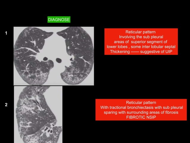 Patterns in HRCT chest | PPTX | Lung and Respiratory Health | Diseases ...
