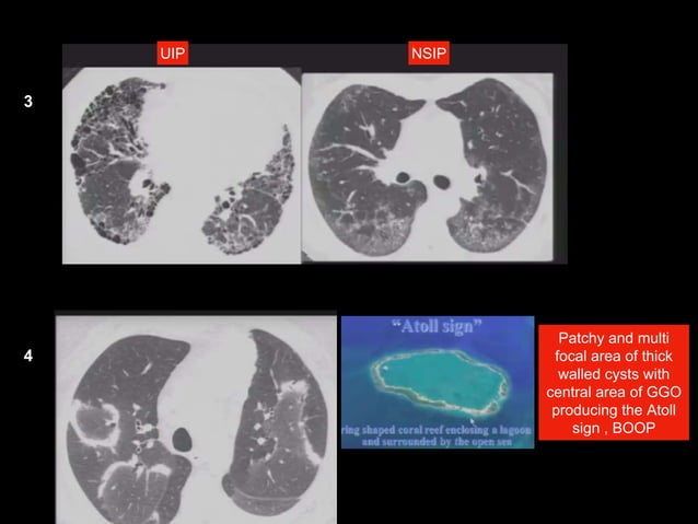 Patterns In Hrct Chest Pptx Lung And Respiratory Health Diseases And Conditions