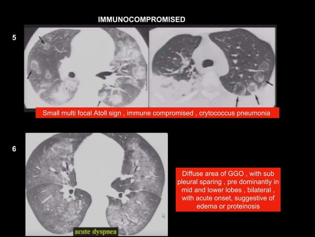 Patterns in HRCT chest | PPTX | Lung and Respiratory Health | Diseases ...