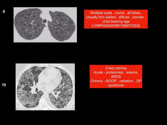 Patterns in HRCT chest | PPTX | Lung and Respiratory Health | Diseases and Conditions