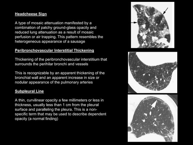 Patterns In Hrct Chest Pptx Lung And Respiratory Health Diseases And Conditions