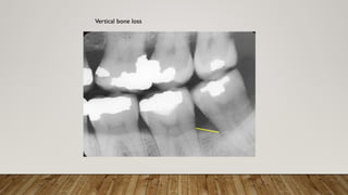 Patterns of bone loss in periodontal diseases | PPTX