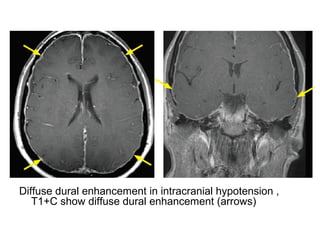 Patterns of Enhancement in the Brain | PPT