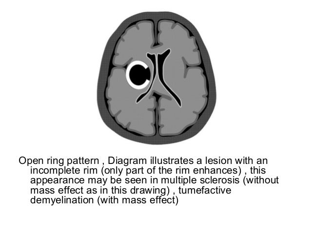 Patterns of Enhancement in the Brain