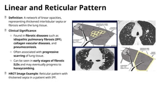 Patterns of Lung disease in HRCT_SRP 2025.pptx