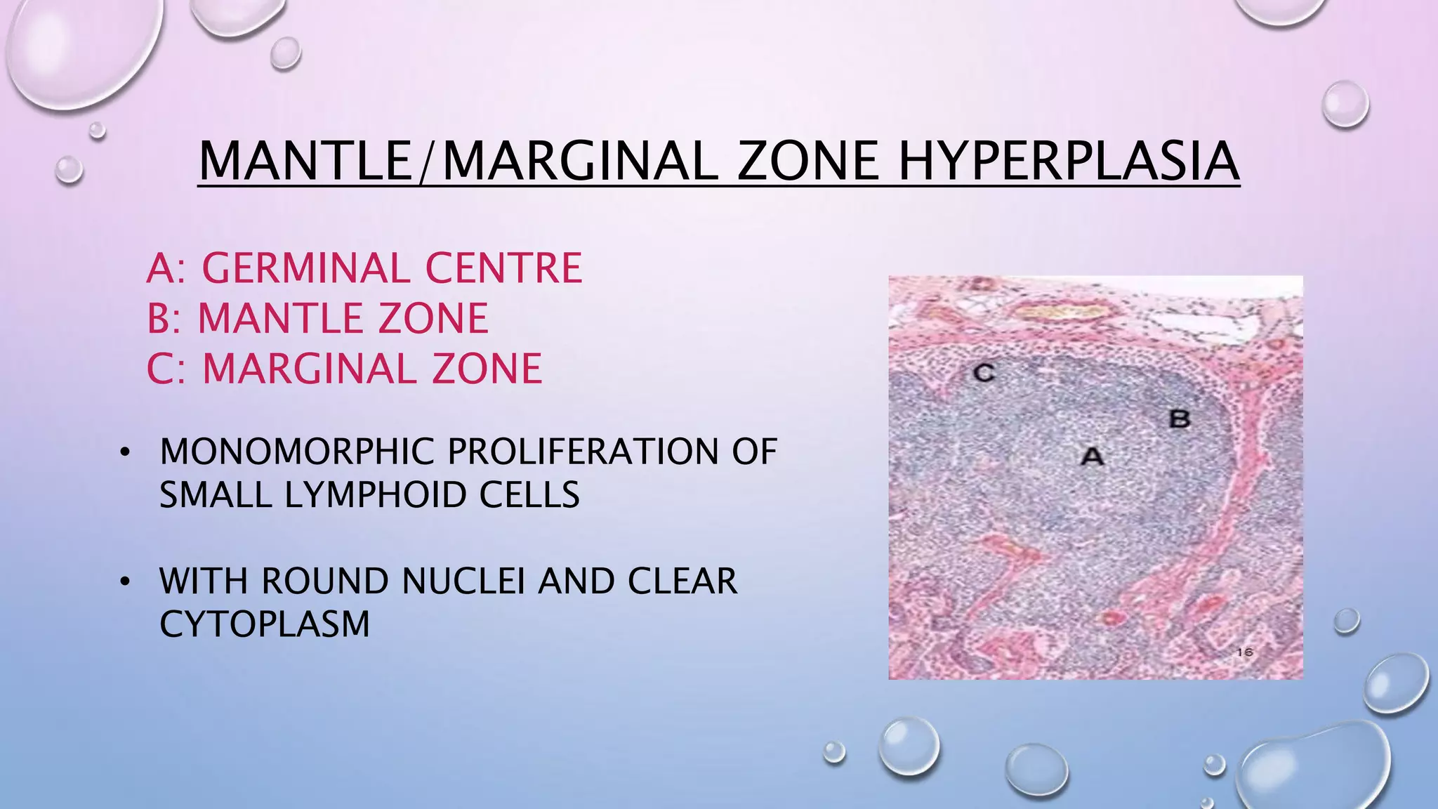 Patterns of lymph node hyperplasia | PPTX