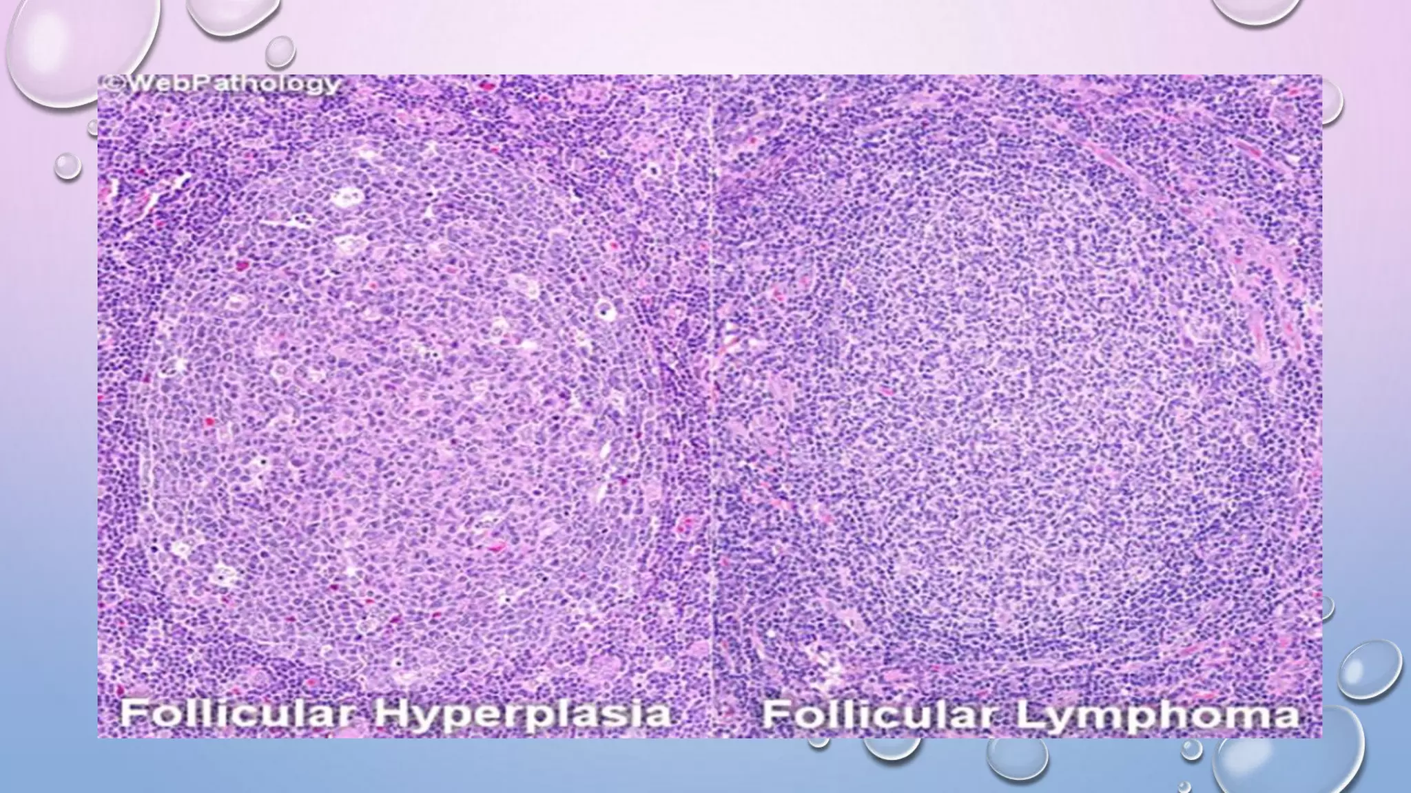 Patterns of lymph node hyperplasia | PPTX