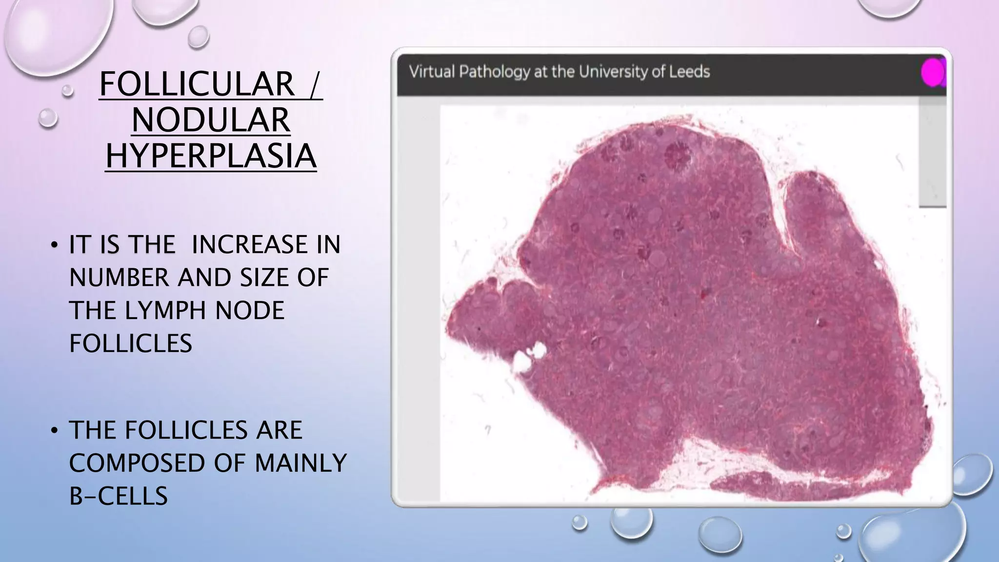 Patterns of lymph node hyperplasia | PPTX