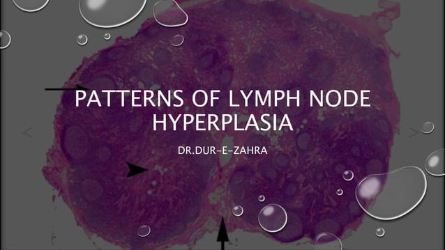 Patterns of lymph node hyperplasia | PPTX