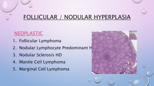 Patterns of lymph node hyperplasia | PPTX