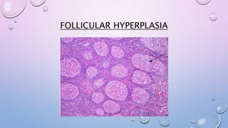 Patterns of lymph node hyperplasia | PPTX
