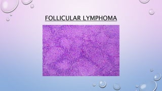 Patterns of lymph node hyperplasia | PPTX
