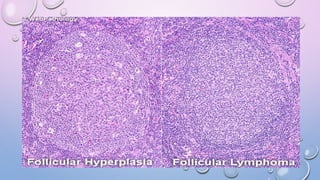 Patterns of lymph node hyperplasia | PPTX