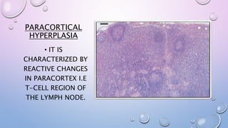 Patterns of lymph node hyperplasia | PPTX