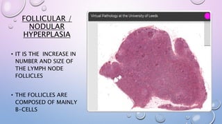 Patterns of lymph node hyperplasia | PPTX