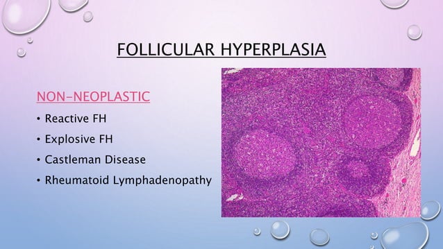 Patterns of lymph node hyperplasia | PPTX