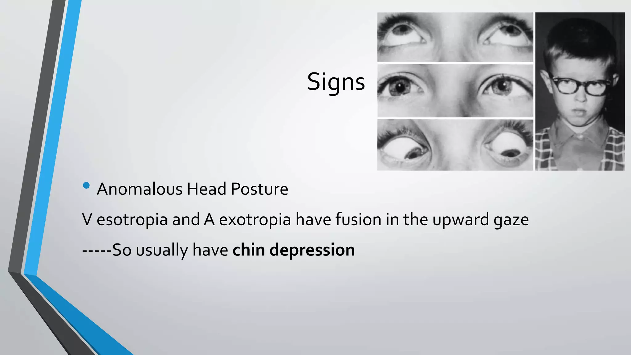 Pattern strabismus | PPTX