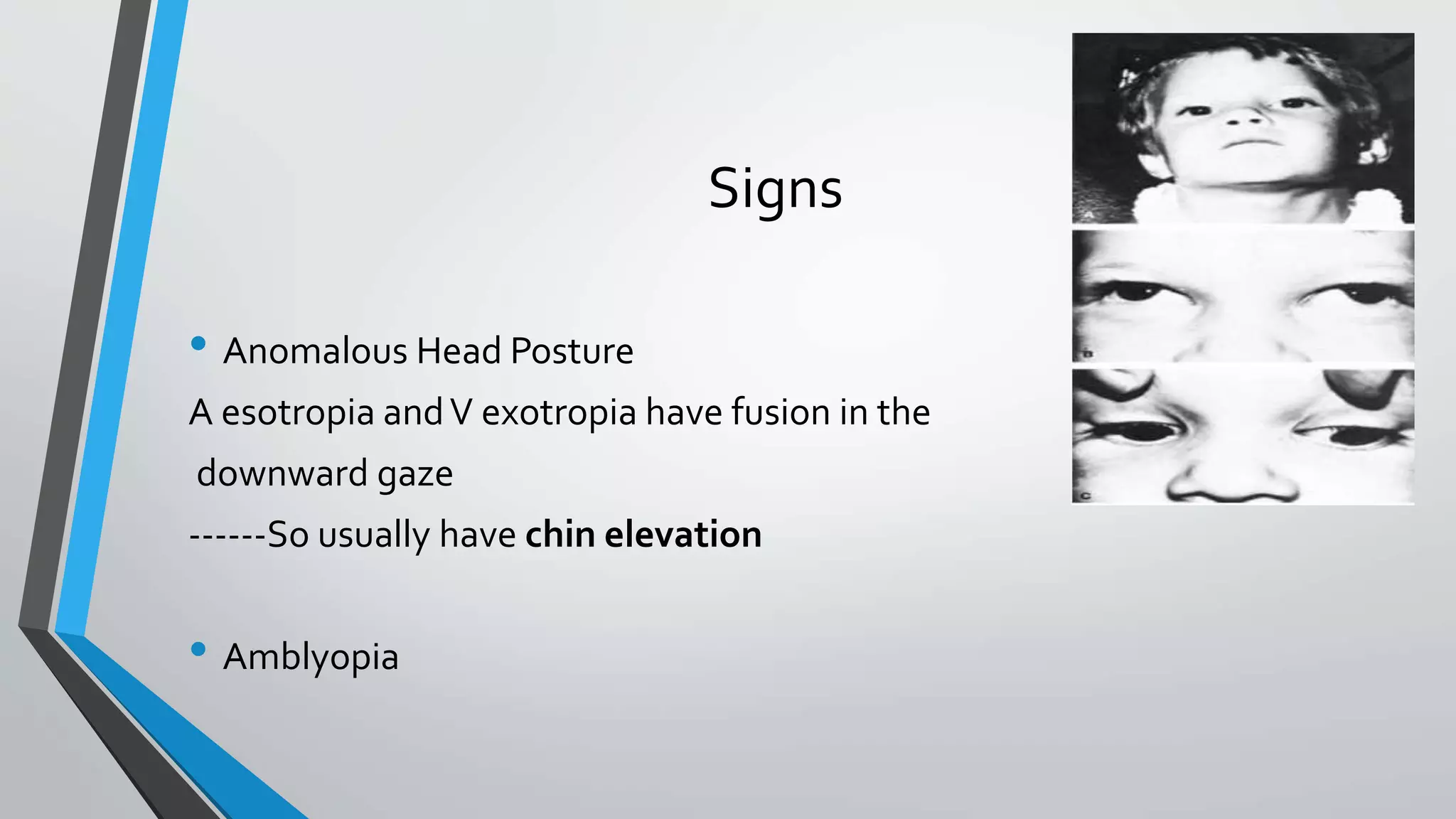 Pattern strabismus | PPTX