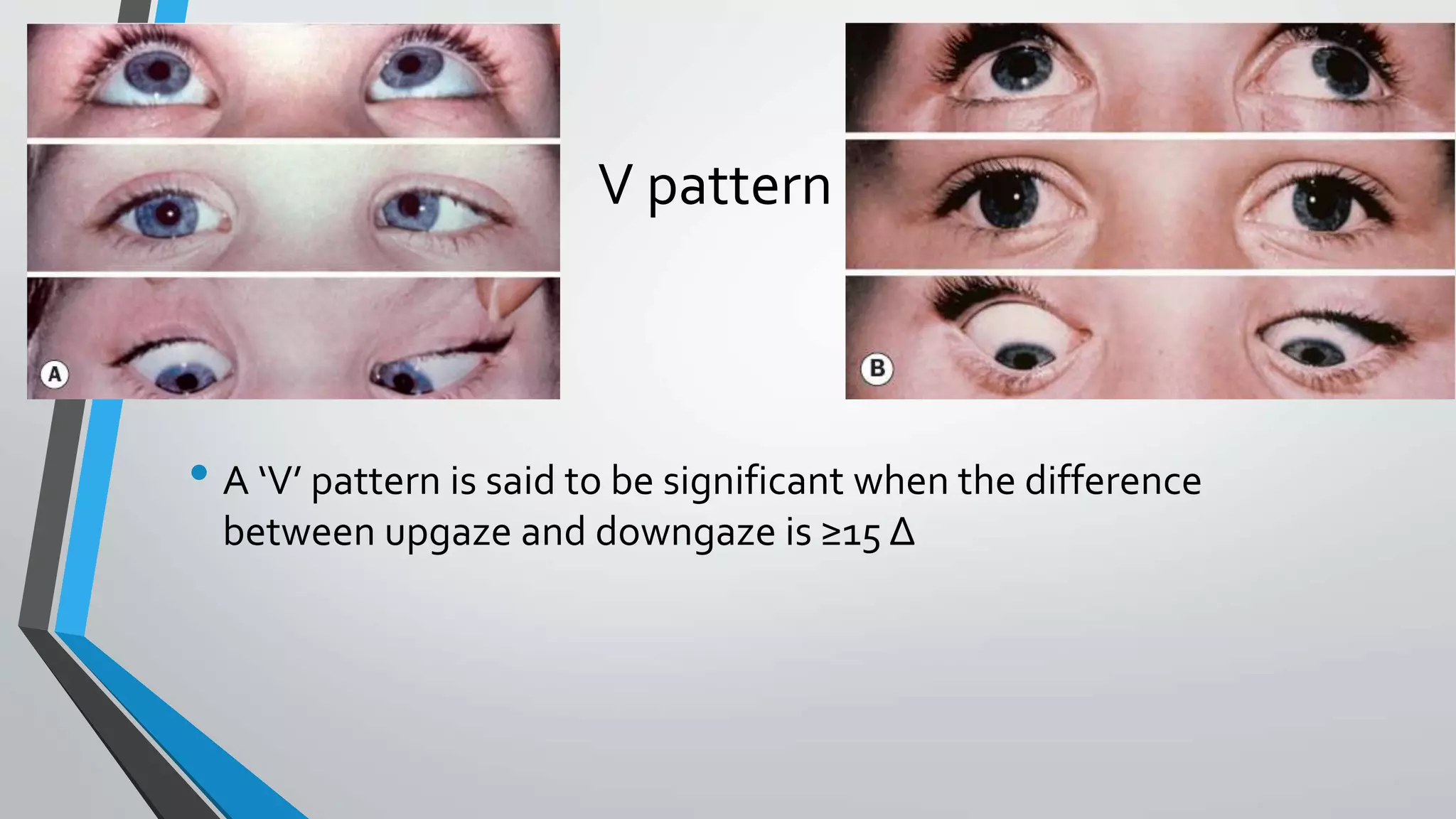 Pattern strabismus | PPTX