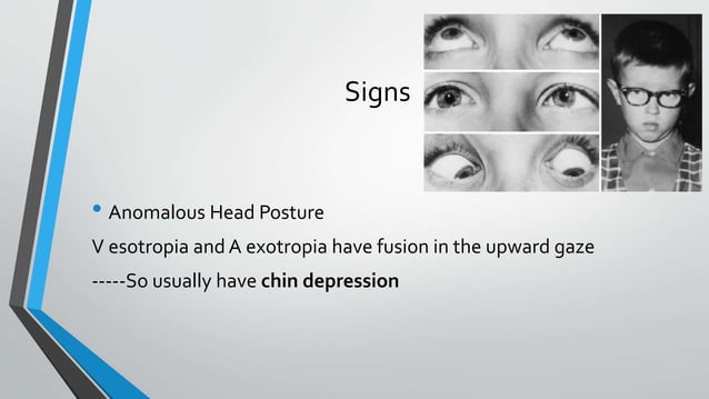 Pattern strabismus | PPTX | Eye and Vision Conditions | Diseases and ...