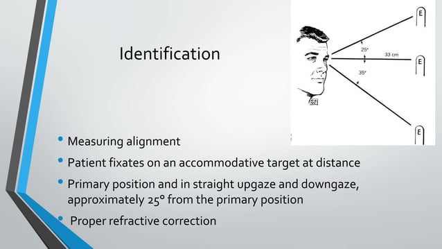 Pattern strabismus | PPTX | Eye and Vision Conditions | Diseases and Conditions