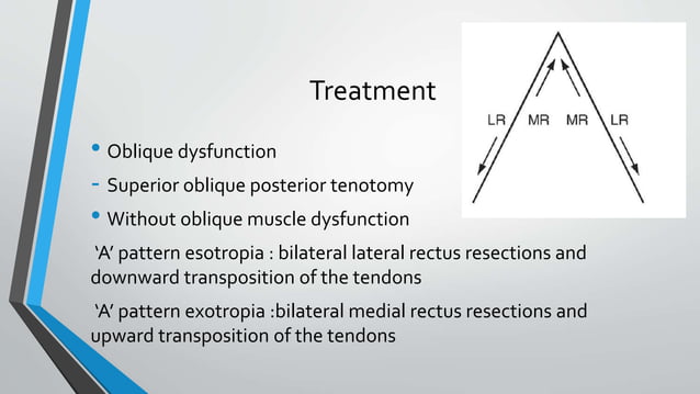 Pattern strabismus | PPTX | Eye and Vision Conditions | Diseases and ...