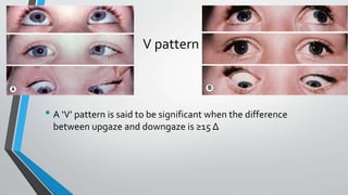Pattern strabismus | PPT