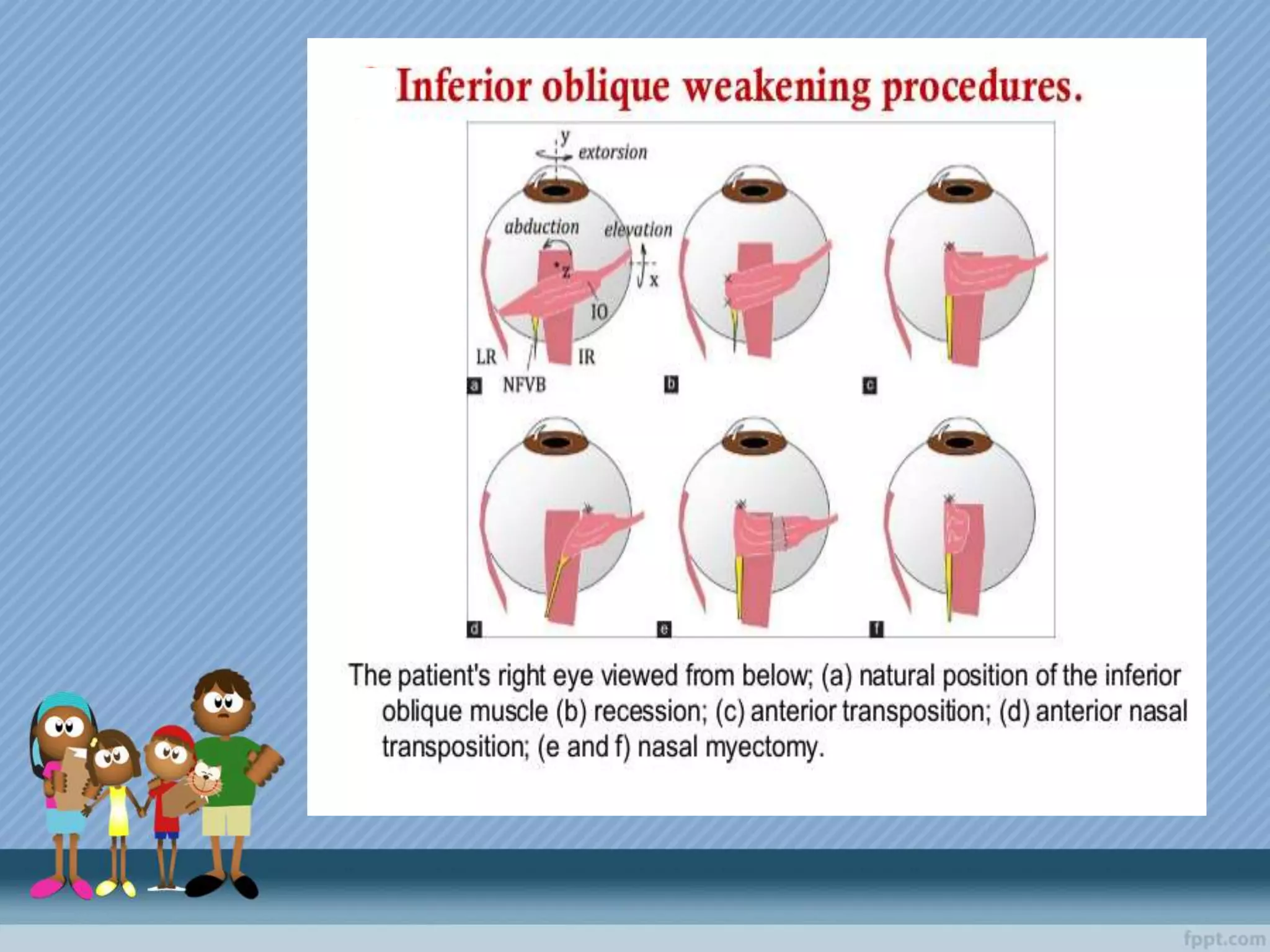 Pattern Strabismus.ppt