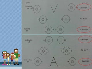 Pattern Strabismus.ppt