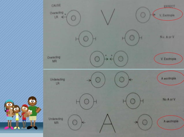 Pattern Strabismus.ppt