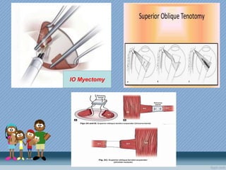 Pattern Strabismus.ppt