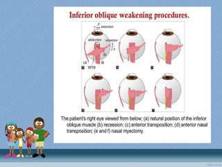 Pattern Strabismus.ppt