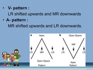 Pattern Strabismus.ppt
