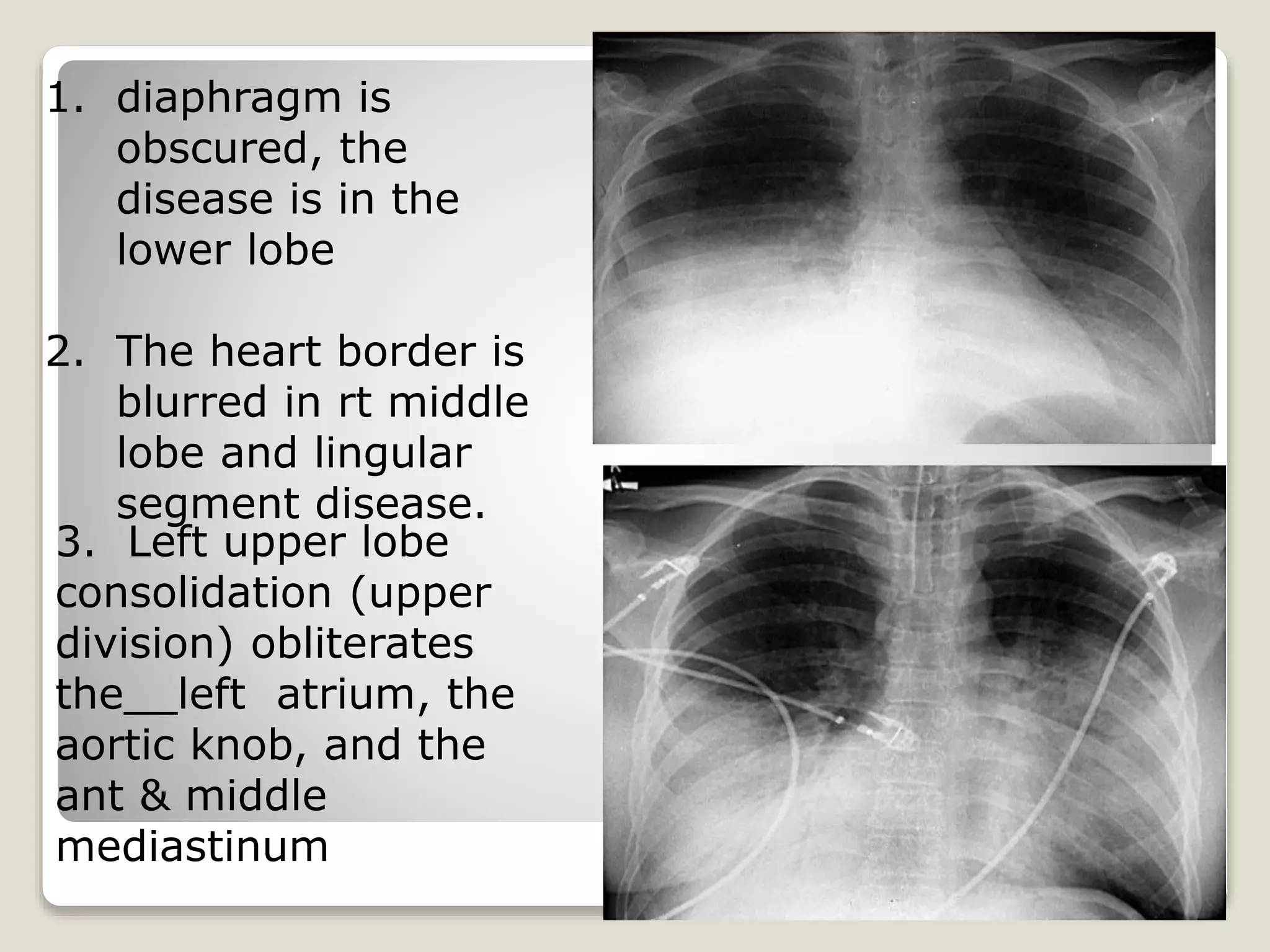 Patttern of lung disease on chest x ray | PPTX