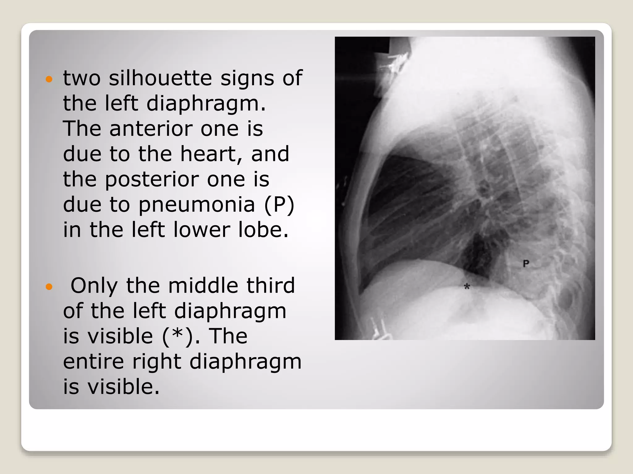Patttern of lung disease on chest x ray | PPTX