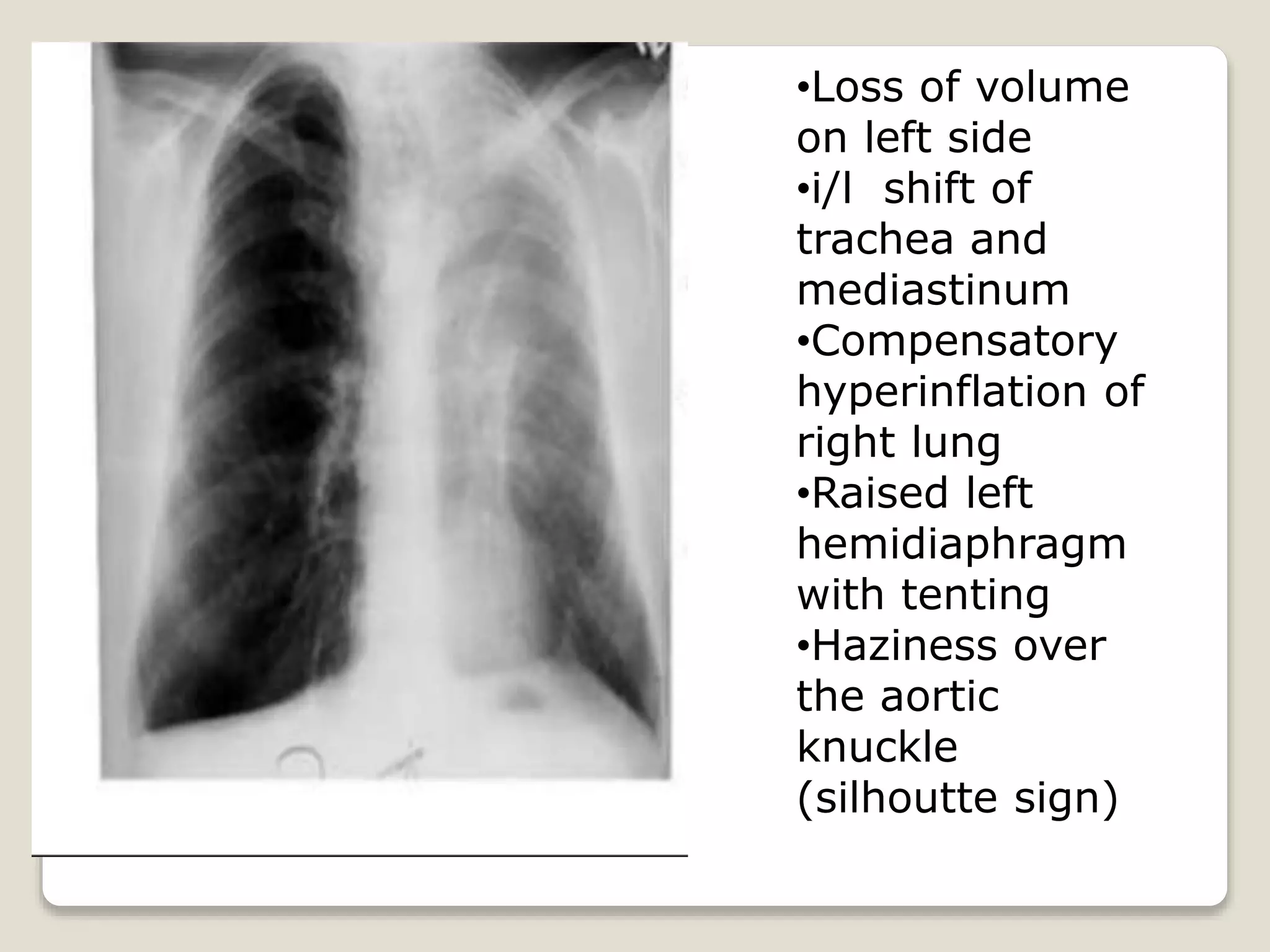 Patttern of lung disease on chest x ray | PPTX