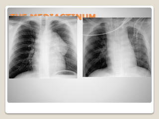 Patttern of lung disease on chest x ray | PPTX