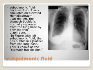 Patttern of lung disease on chest x ray | PPTX