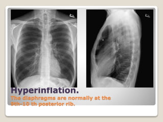 Patttern of lung disease on chest x ray | PPTX
