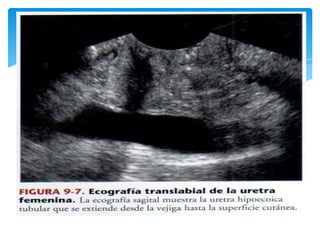 Ultrasonido Extrofia Vesical