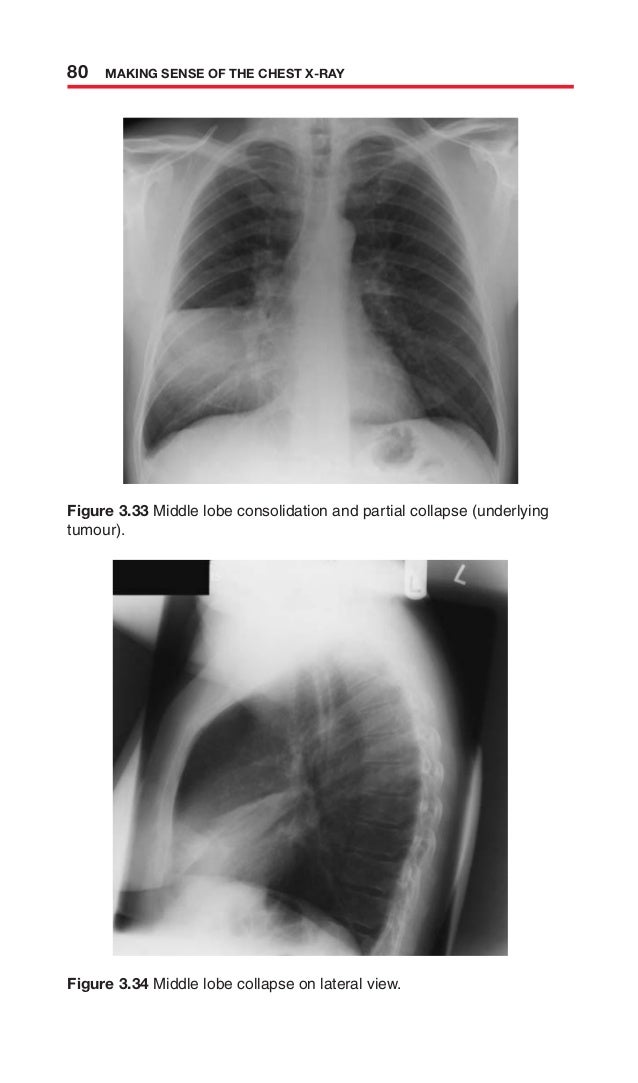 Chest Xray Simple English Wikipedia The Free Encyclopedia