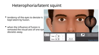 Squint ,types,heterophoria.pptx.......... | PPTX