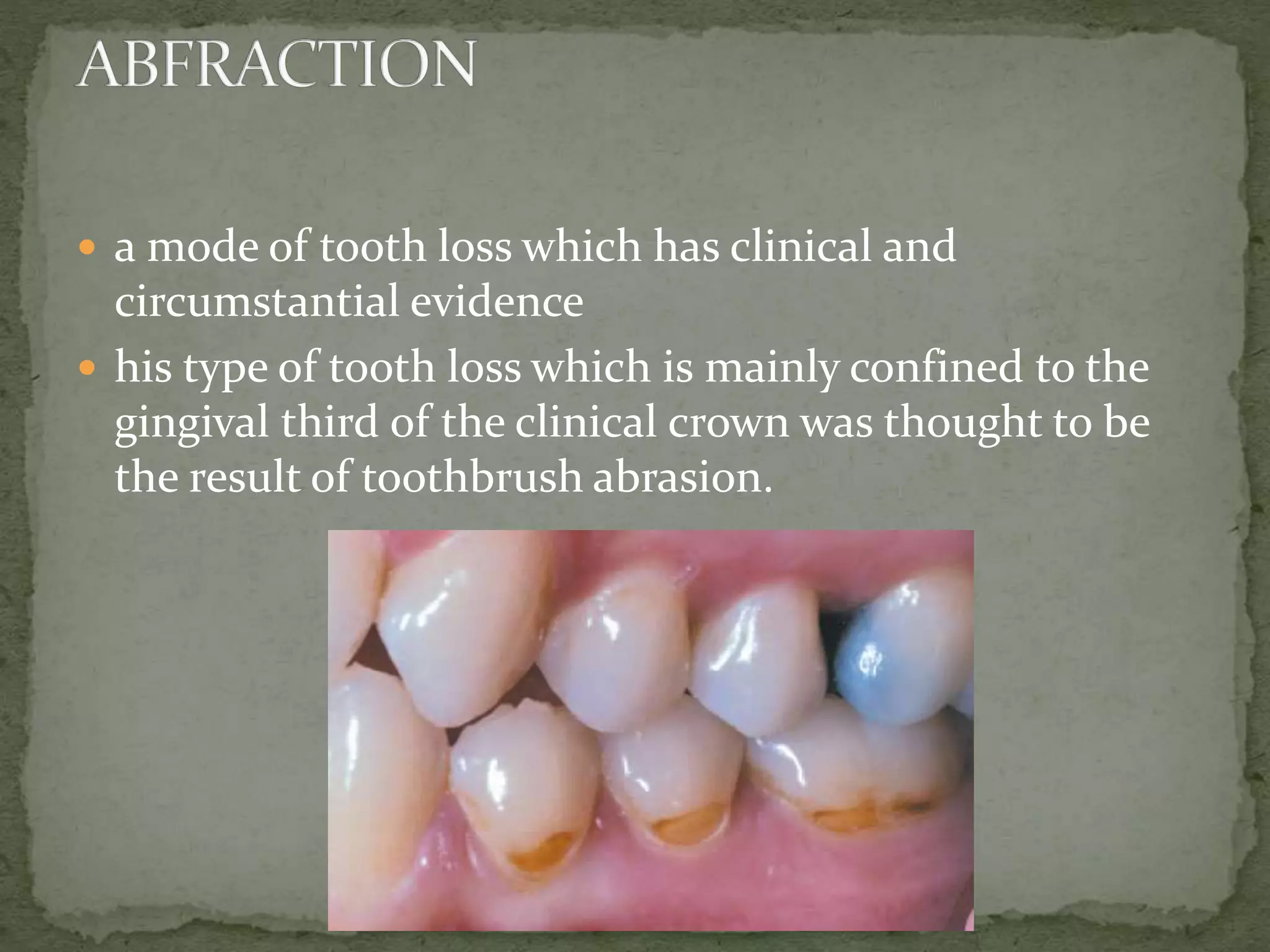 EROSION AND ABFRACTION | PPTX