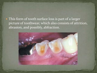 EROSION AND ABFRACTION | PPTX